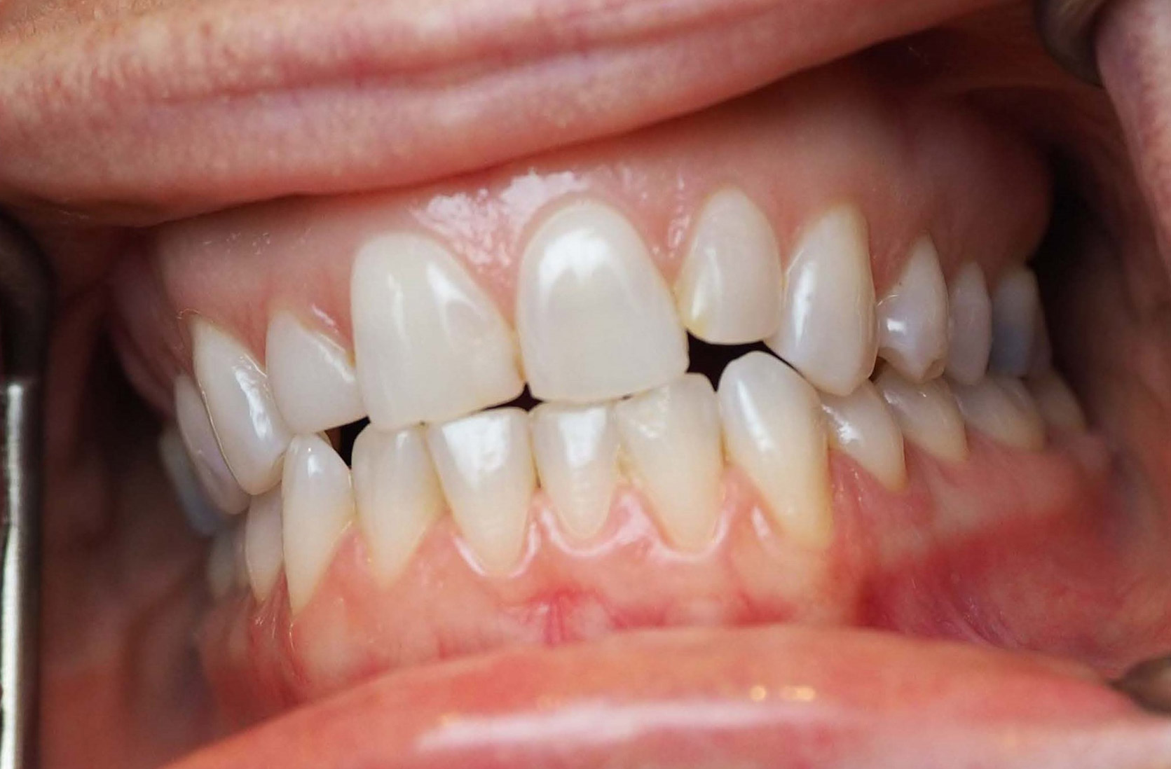 Smile Gallery - See Smiles Transform - River Valley Dentistry